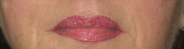 Permanent cosmetic solutions | Lips