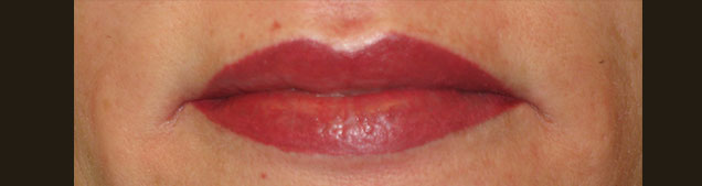 Permanent cosmetic solutions | Lips