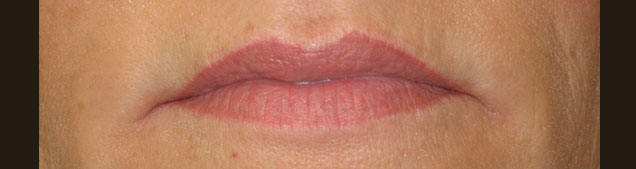 Permanent cosmetic solutions | Lips